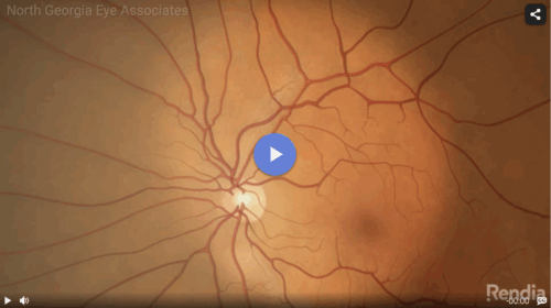 Retina Care Gainesville | Retinal Condition Clayton | Braselton, GA
